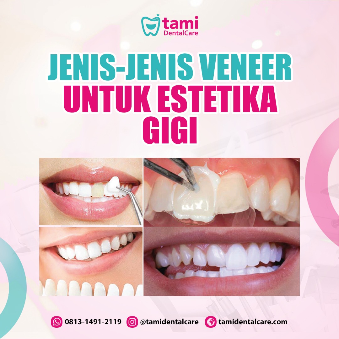 Jenis-Jenis Veneer untuk Estetika Gigi – Tami Dental Care – Klinik Gigi ...