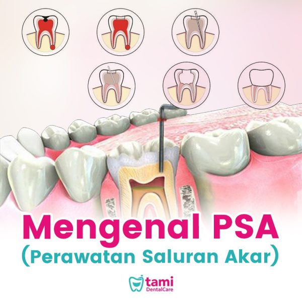 MENGENAL PSA – Tami Dental Care – Klinik Gigi Dokter Gigi Terbaik ...